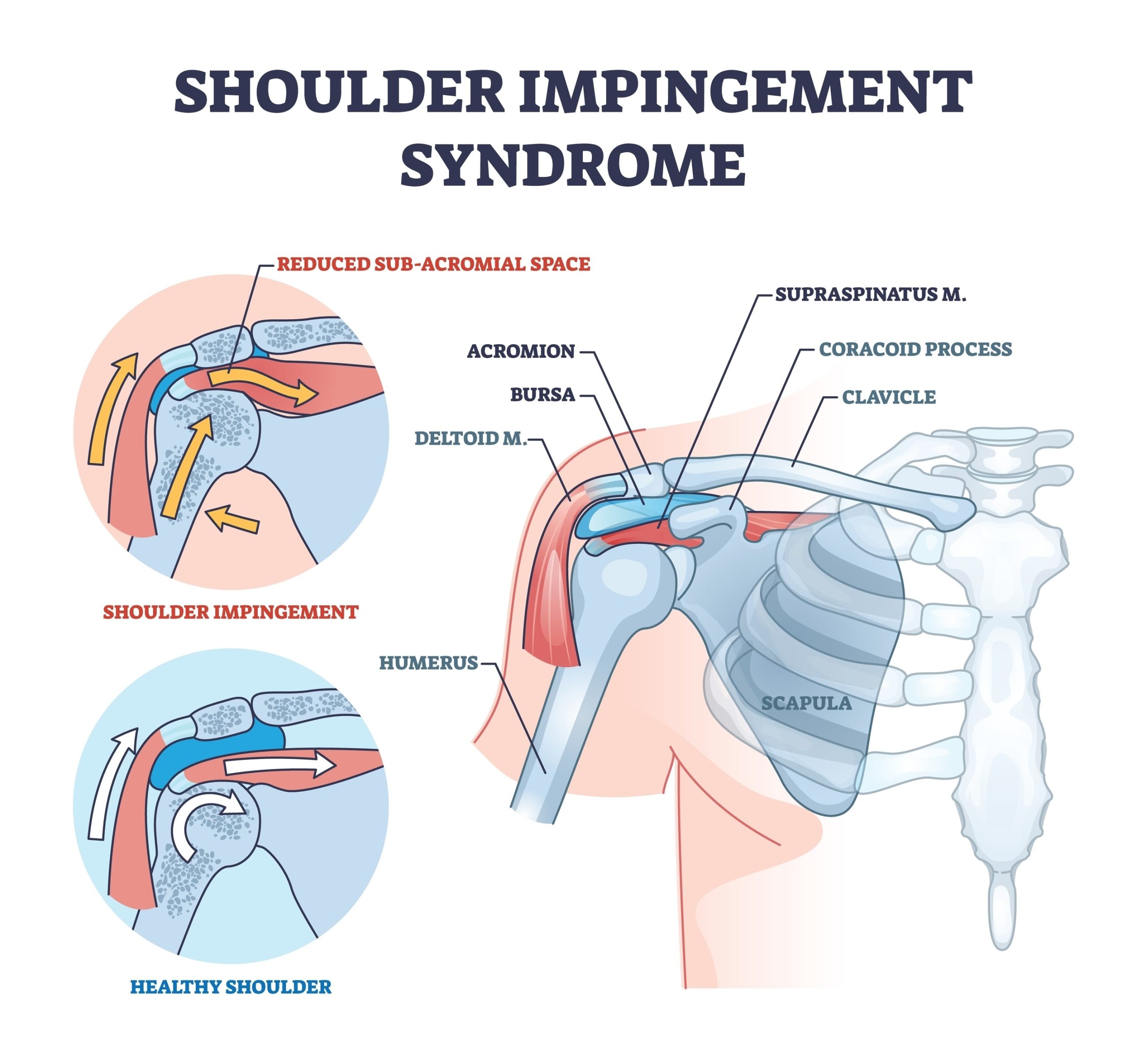 Bodybuilder Shoulder Pain Treatment in Centennial, CO: Evidence-Based ...